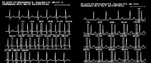 Scanner - Imagerie des malformations cardiaques