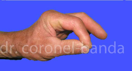 Traumatismos de la mano - Web page Mauricio Coronel Banda