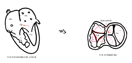 Canal Type Atrioventricular Chordal Attachments Defects Rastelli Av ...