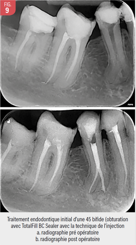 AO 58 Obturation canalaire ciments biocéramiques A. Achouche - AOnews ...