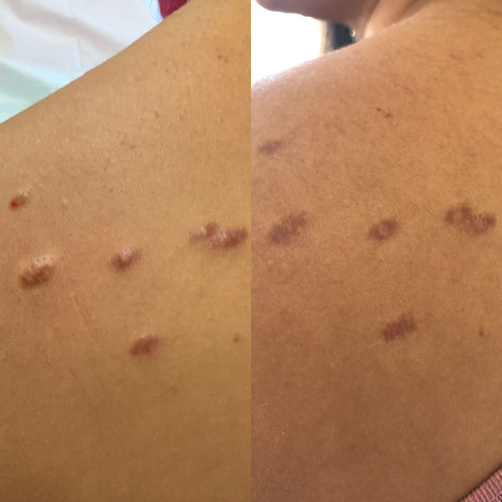 Narben behandeln, Chirurgie, Laser, Kälte! Hautarzt Linz - Dr. Barsch