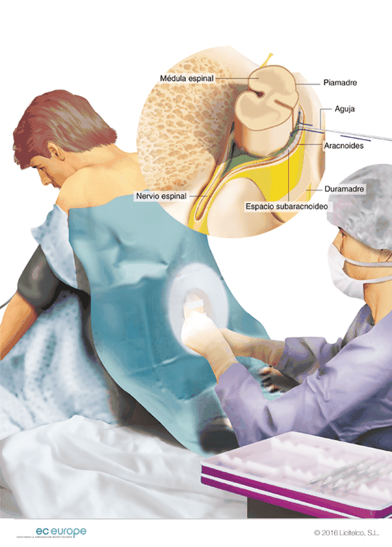 La TURP - Dr Carlo Negro - Urologo, andrologo