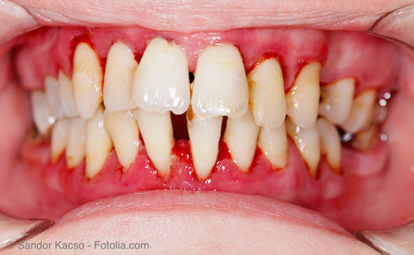 Parodontitis-Symptome - Zahnarztpraxis Eberl
