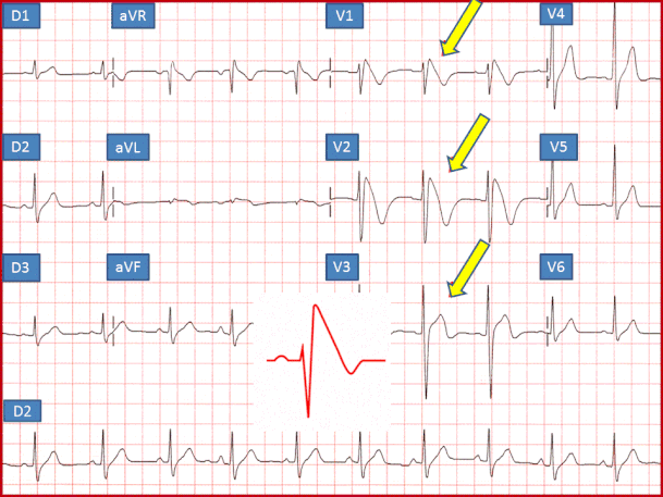 -La sindrome di Brugada - gennarino borrello