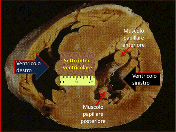 *Cardiomiopatia ipertrofica - gennarino borrello