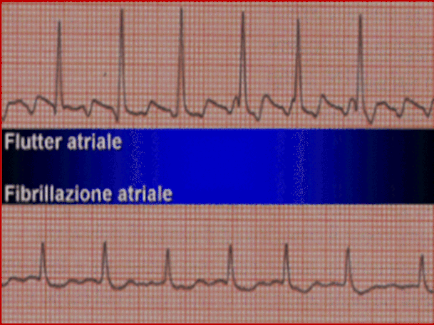 *Le aritmie cardiache - gennarino borrello