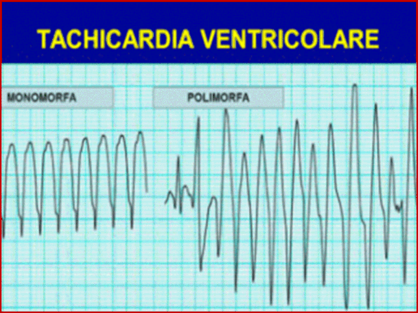 *Le aritmie cardiache - gennarino borrello