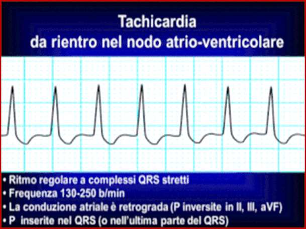 *Le aritmie cardiache - gennarino borrello