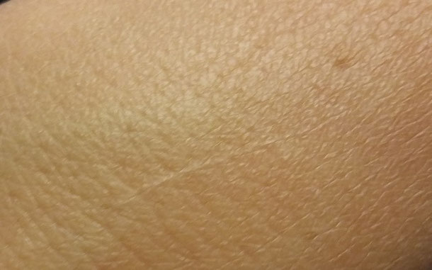 Cicatriz De Toracotomia Cicatrizada Untitled