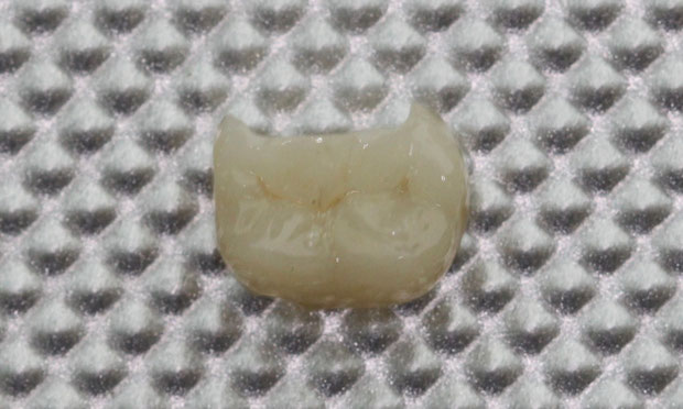 Teil - Kronen & Onlays schonen Zahnhartsubstanz - Zahnarzt Hauzenberg ...