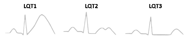 Long-QT-Syndrom - Fokus-EKG