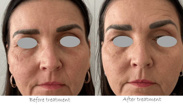 Polynucleotide treatment - Skin Clinic