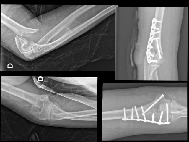 FRACTURE DU COUDE - Dr Rémi : chirurgien orthopédiste à Toulouse