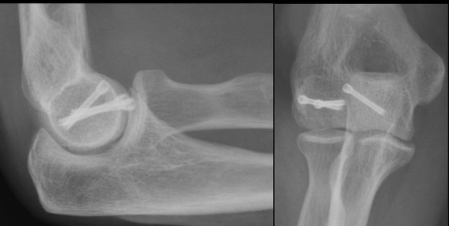 FRACTURE DU COUDE - Dr Rémi : chirurgien orthopédiste à Toulouse