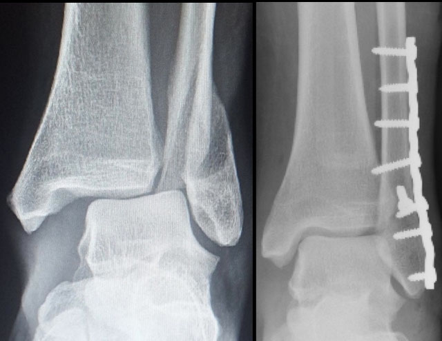 FRACTURE CHEVILLE - Dr Rémi : chirurgien orthopédiste à Toulouse