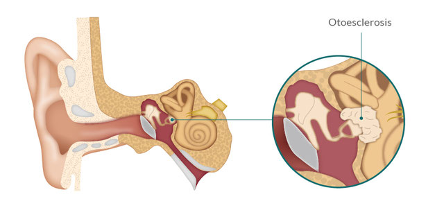 Exploración y tratamiento de la otosclerosis - Centro Auditivo Cuenca ...