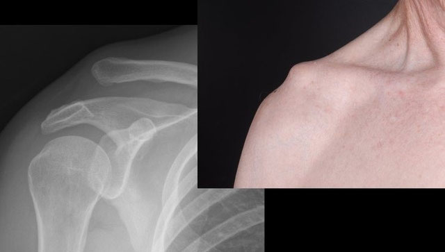 Schultereckgelenksprenung (AC-Luxation) - ortho-clinics Webseite!