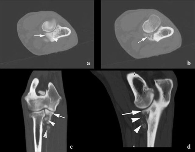 A chondroblastic osteosarcoma of the coronoid process mimicking a ...