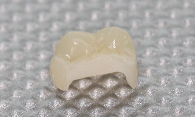 Teil - Kronen & Onlays schonen Zahnhartsubstanz - Zahnarzt Hauzenberg ...