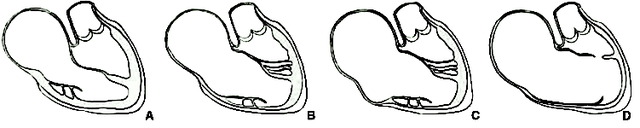 Maladie d'Ebstein - Imagerie des malformations cardiaques