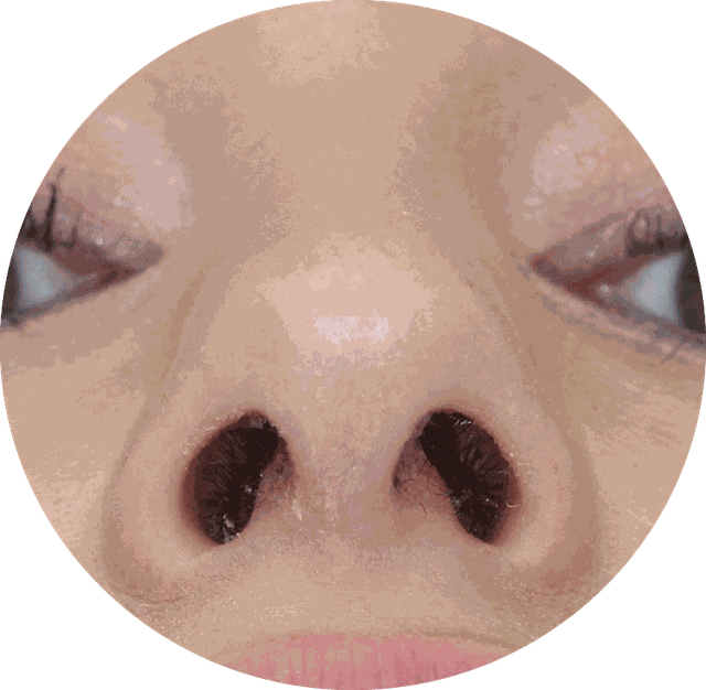 Open nose surgery Hamburg - Dr. Kovacevic