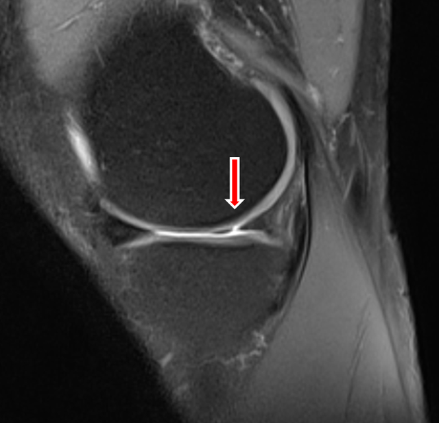 LESION MENISCALE - Dr Rémi : chirurgien orthopédiste à Toulouse