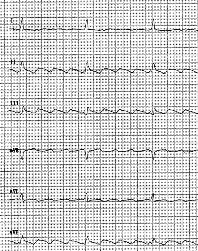 Vorhofflattern - Fokus-EKG