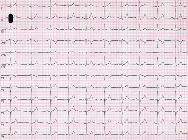 Rs Umschlag Ekg _ In 7 Schritten zum EKG-Befund – XSZY
