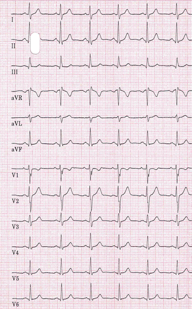 EKG bei Elektrodenvertauschung - Fokus-EKG