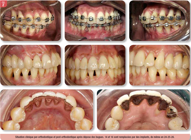Parodontite grade C stade 4 (agressive sévère) et orthodontie - AOnews ...