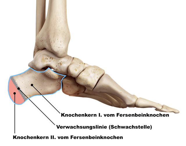 Behandlung Apophysitis Calcanei - Morbus Sever - FERSOmed®