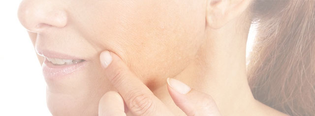 Rimpels rond de mond - Clinica d'Oro