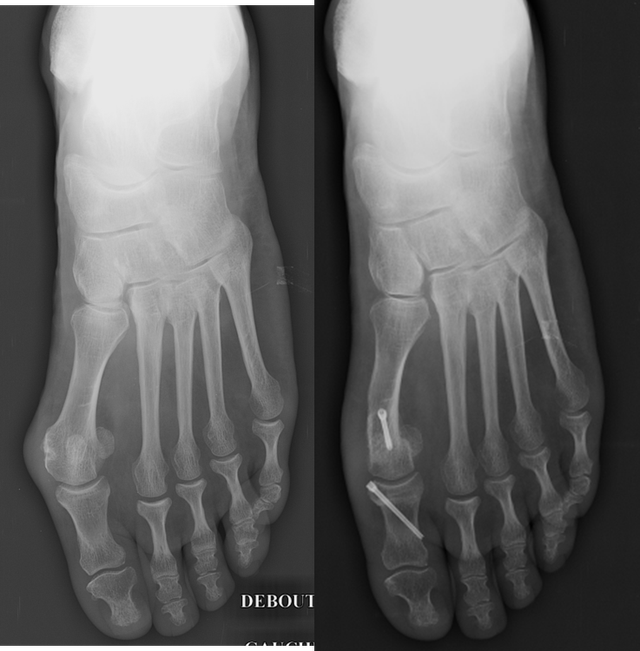 HALLUX VALGUS - Dr Rémi : chirurgien orthopédiste à Toulouse