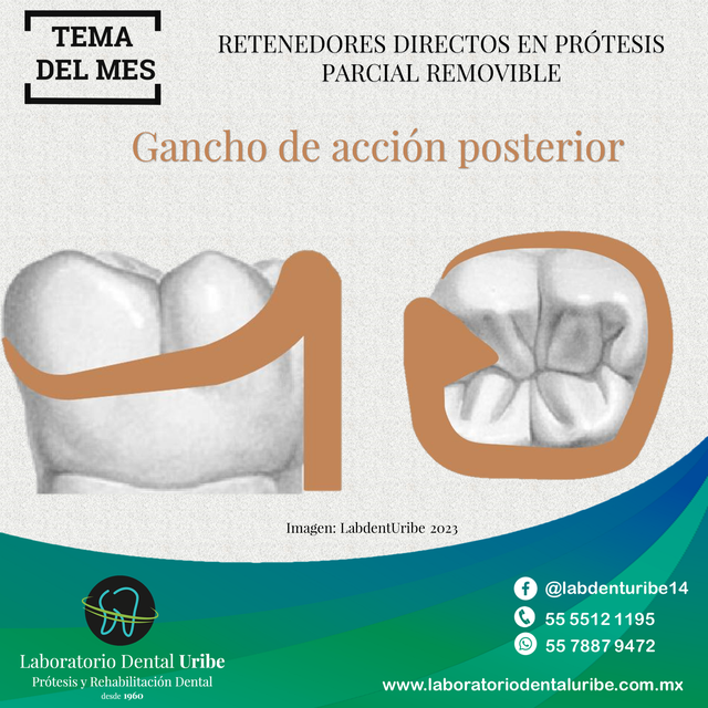 Retenedores directos en prótesis parcial removible - Página web de ...