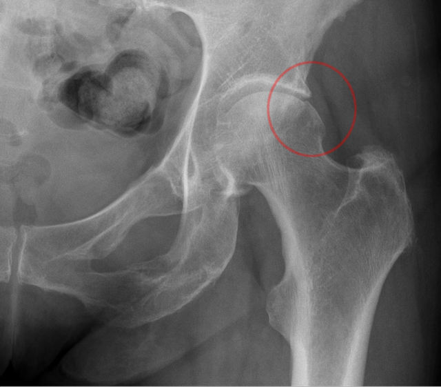 Hüfte Region 2 zentral + medial - see-feel-treats Webseite!