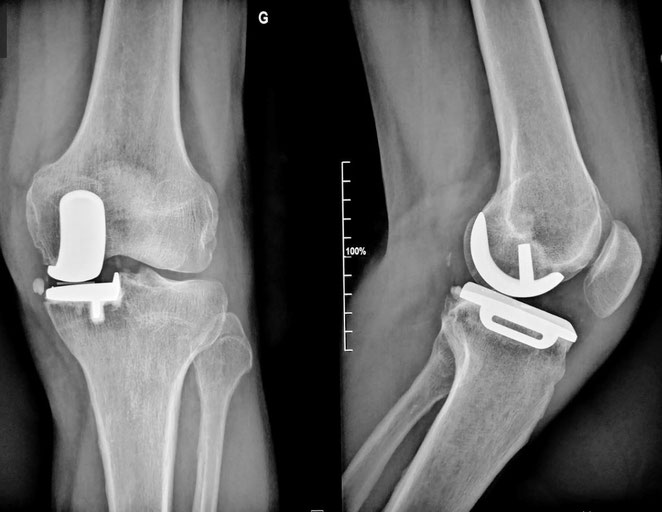 Prothèses de genou - Dr. Zanone Xavier, Chirurgie orthopédique, Genève