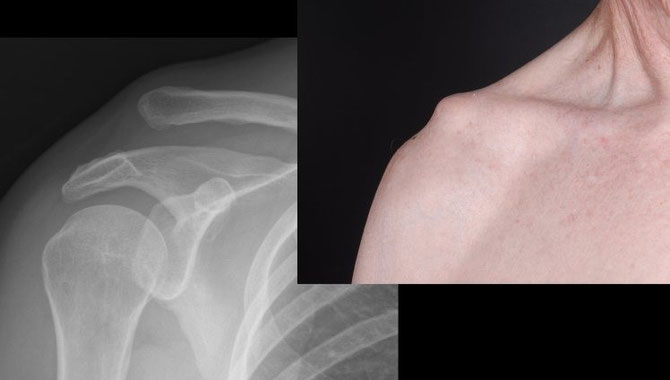 Schultereckgelenksprenung (AC-Luxation) - ortho-clinics Webseite!