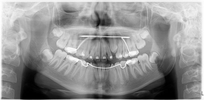 Caso N°557 :Pansinusitis Crónica - CDI