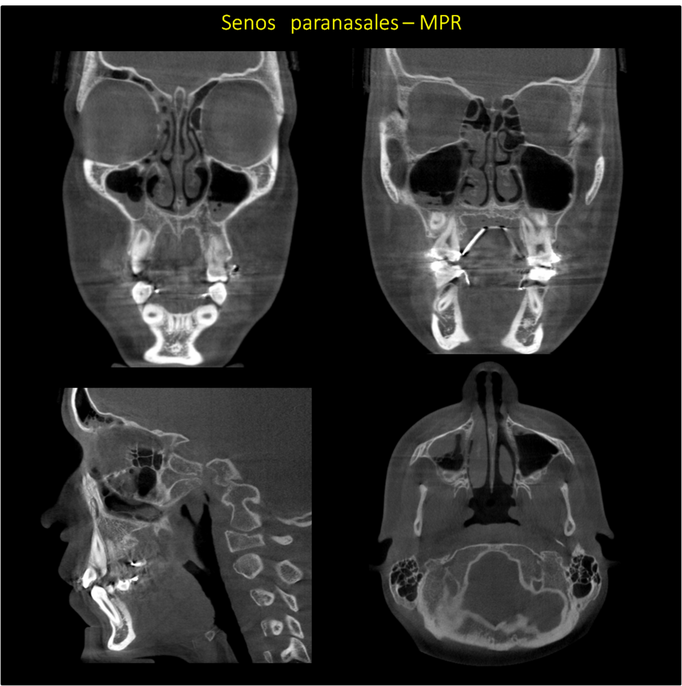 Caso N°557 :Pansinusitis Crónica - CDI