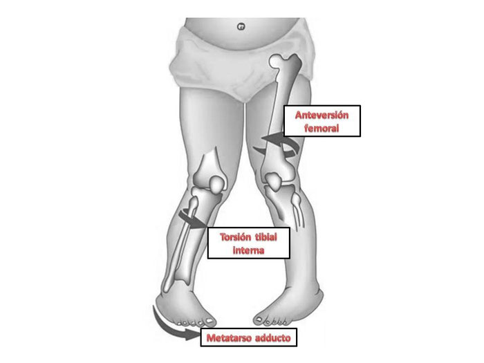 Mi niño "mete el pie"- Intoeing - Dra: Rovira - Página web de ...
