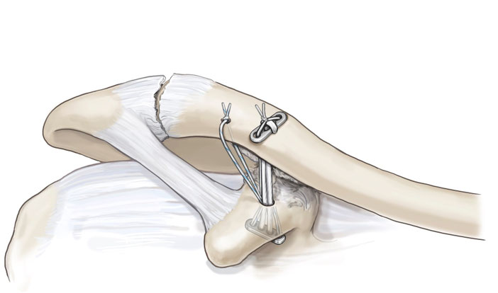 Schultereckgelenksprenung (AC-Luxation) - ortho-clinics Webseite!