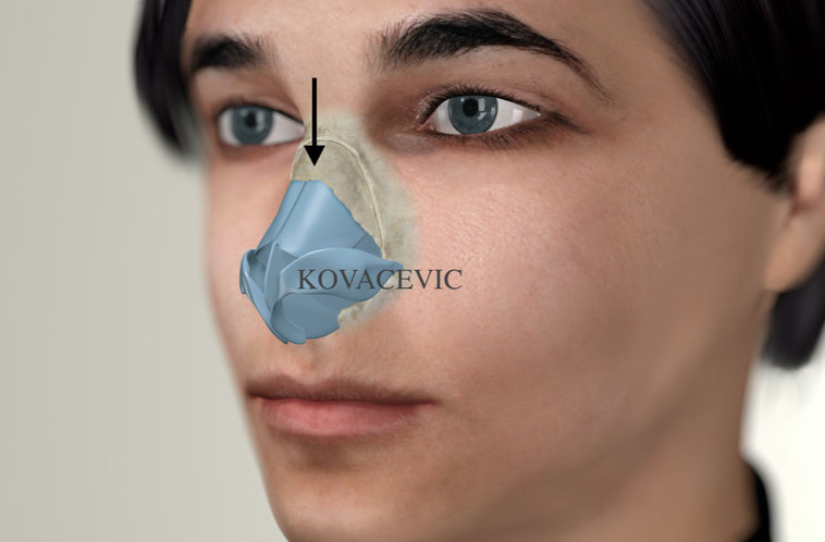 Info on different nose shapes - Dr. Kovacevic