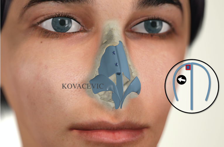 Info on different nose shapes - Dr. Kovacevic