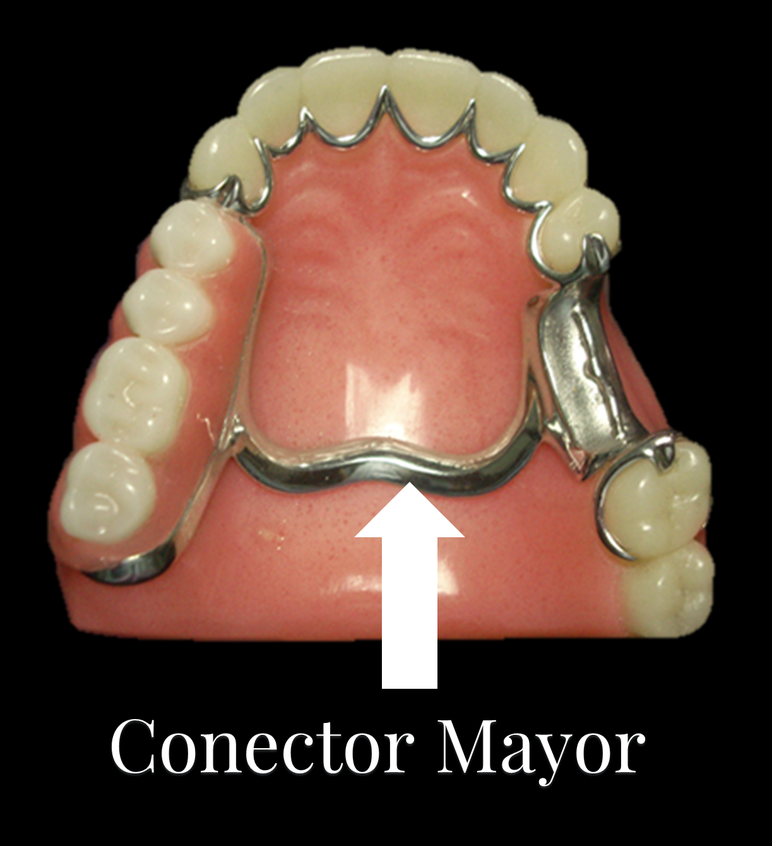 Componentes esenciales de una prótesis parcial removible - Página web ...