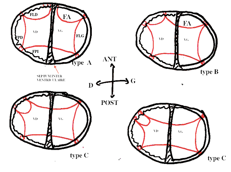 Canal atrioventriculaire - Imagerie des malformations cardiaques