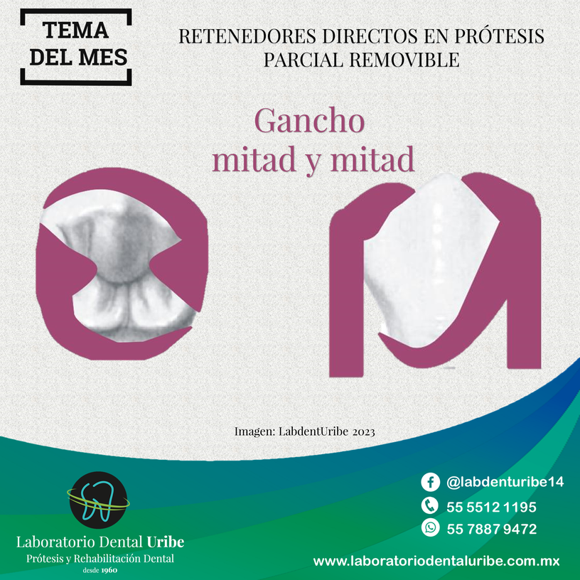 Retenedores directos en prótesis parcial removible - Página web de ...