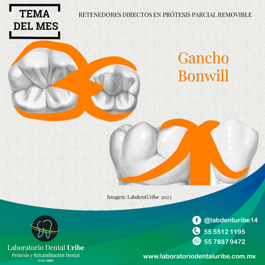 Retenedores directos en prótesis parcial removible - Página web de ...