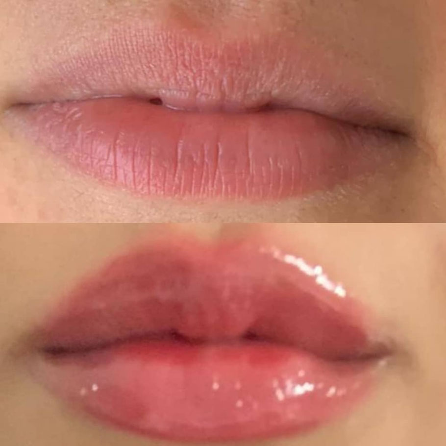 Curso Online de Dermapen + BB Lips - Beauty Center - Escuela de Belleza ...
