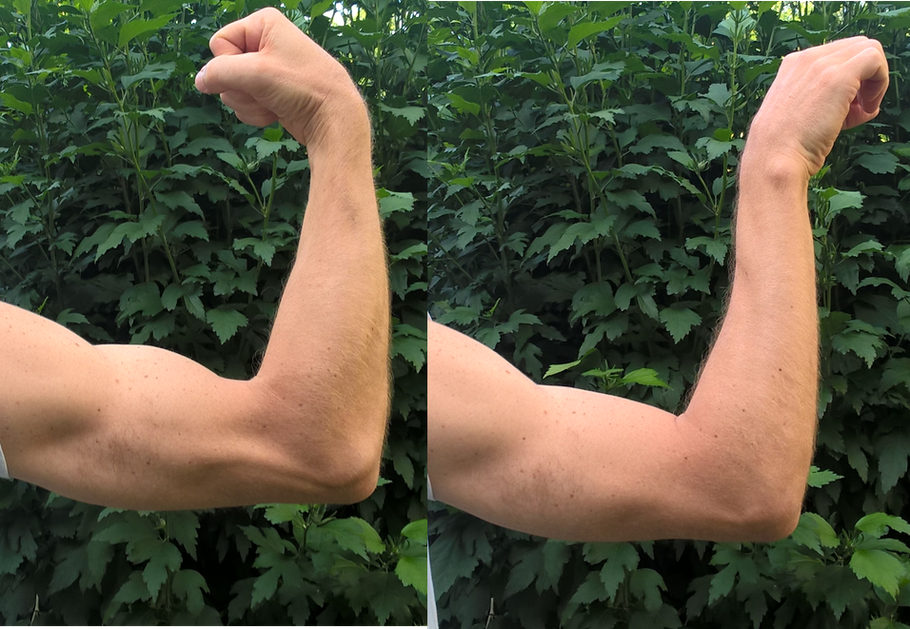 RUPTURE BICEPS - Dr Rémi : chirurgien orthopédiste à Toulouse