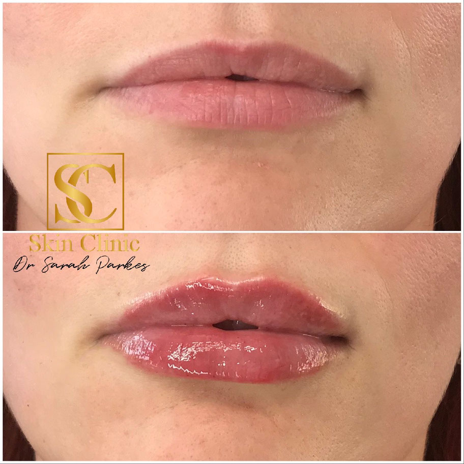Lip Fillers - Skin Clinic